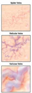 Treating and Removing Reticular Veins