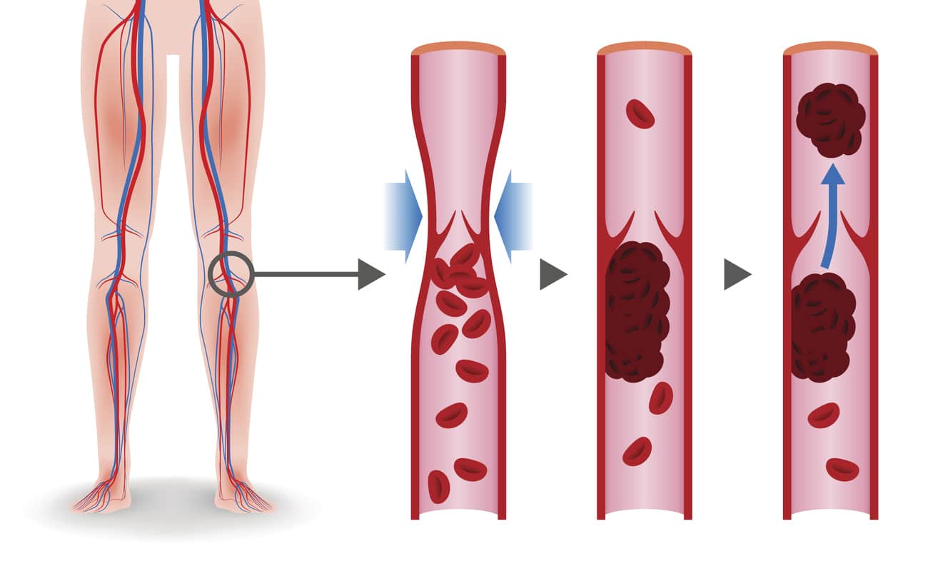 Blood Clots | DVT | Deep Vein Thrombosis | Vein Doctor